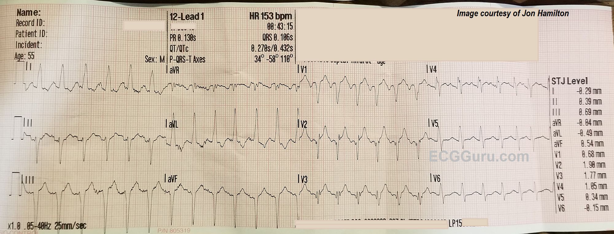 Syncope and tachycardia | ECG Guru - Instructor Resources Syncope and tachycardia | ECG Guru - Instructor Resources